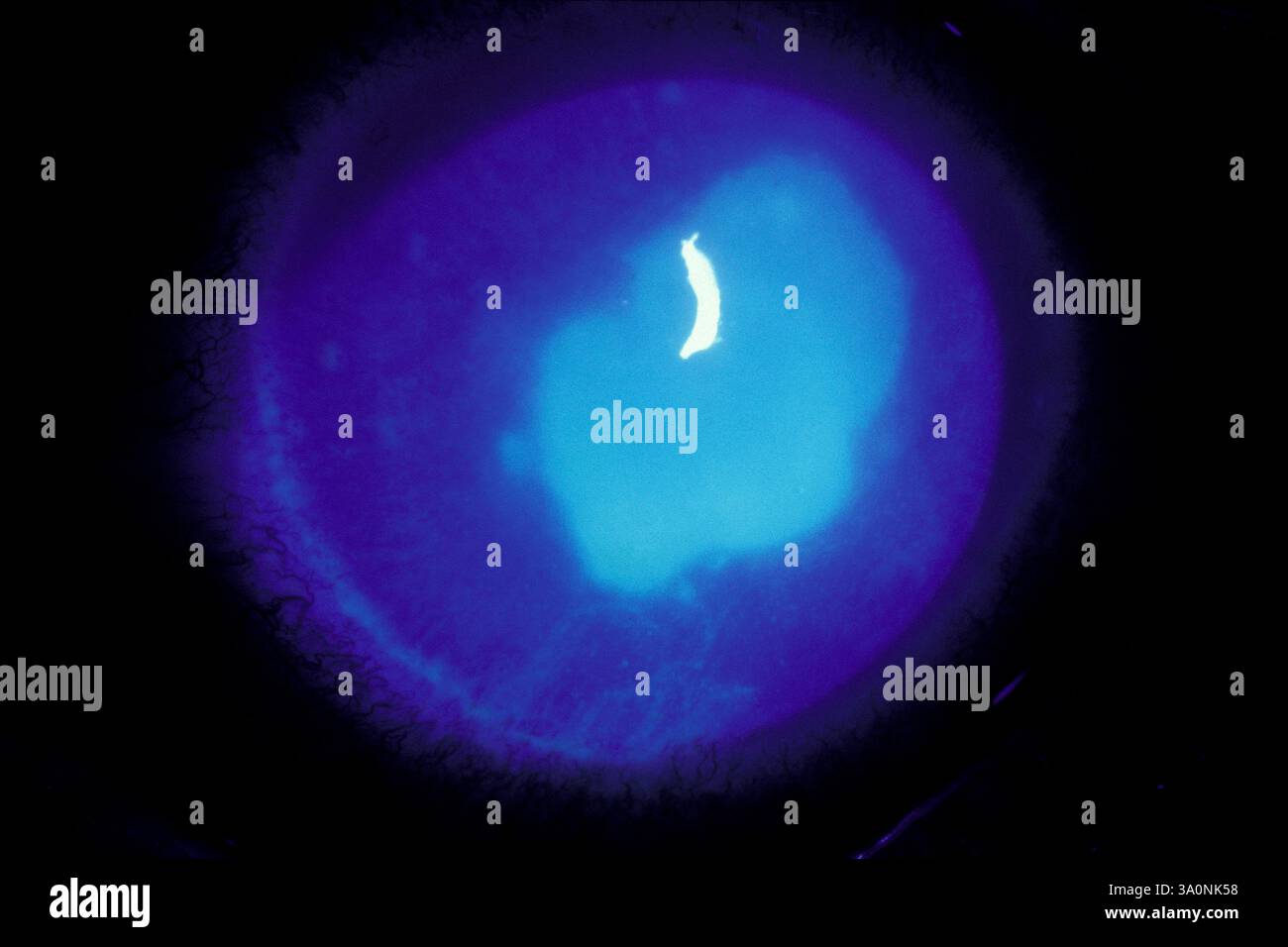 Bacterial keratitis. Fluorescein dye (with blue excitation) being used ...