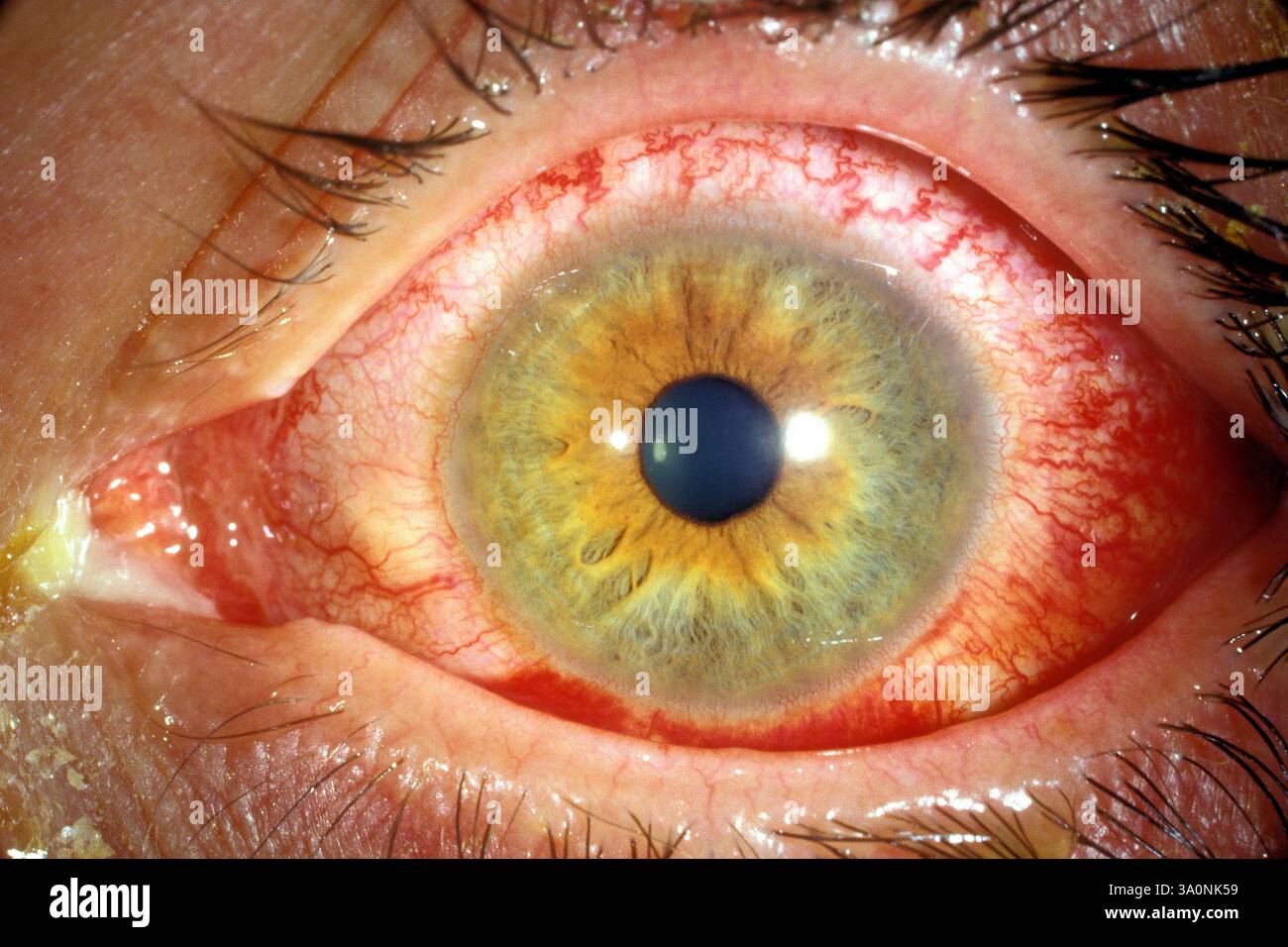 Bacterial conjunctivitis in chlamydia. Close-up of the right eye of a ...