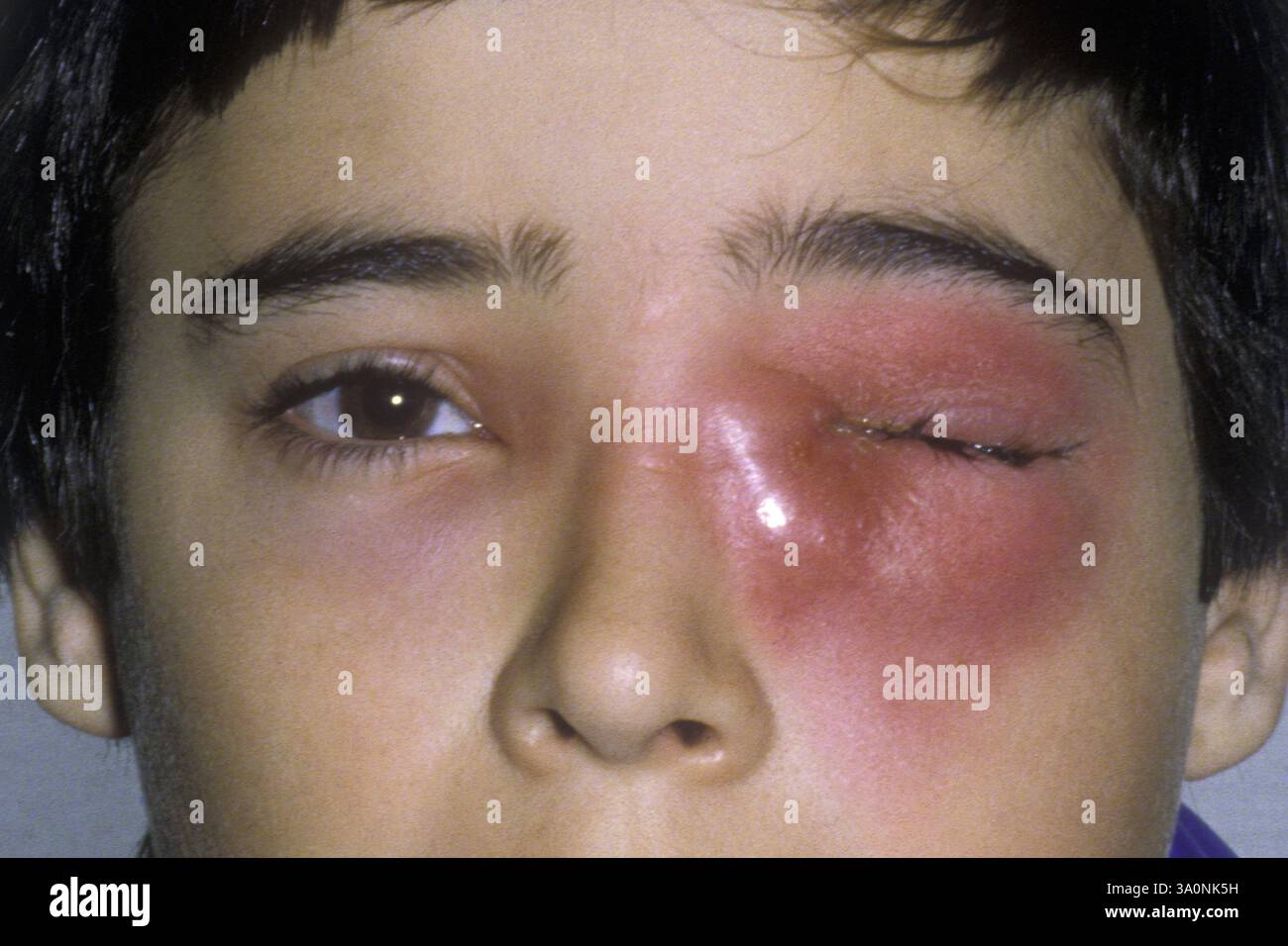 Infected tear sac. Dacryocystitis (inflammation of the lacrimal (tear ...