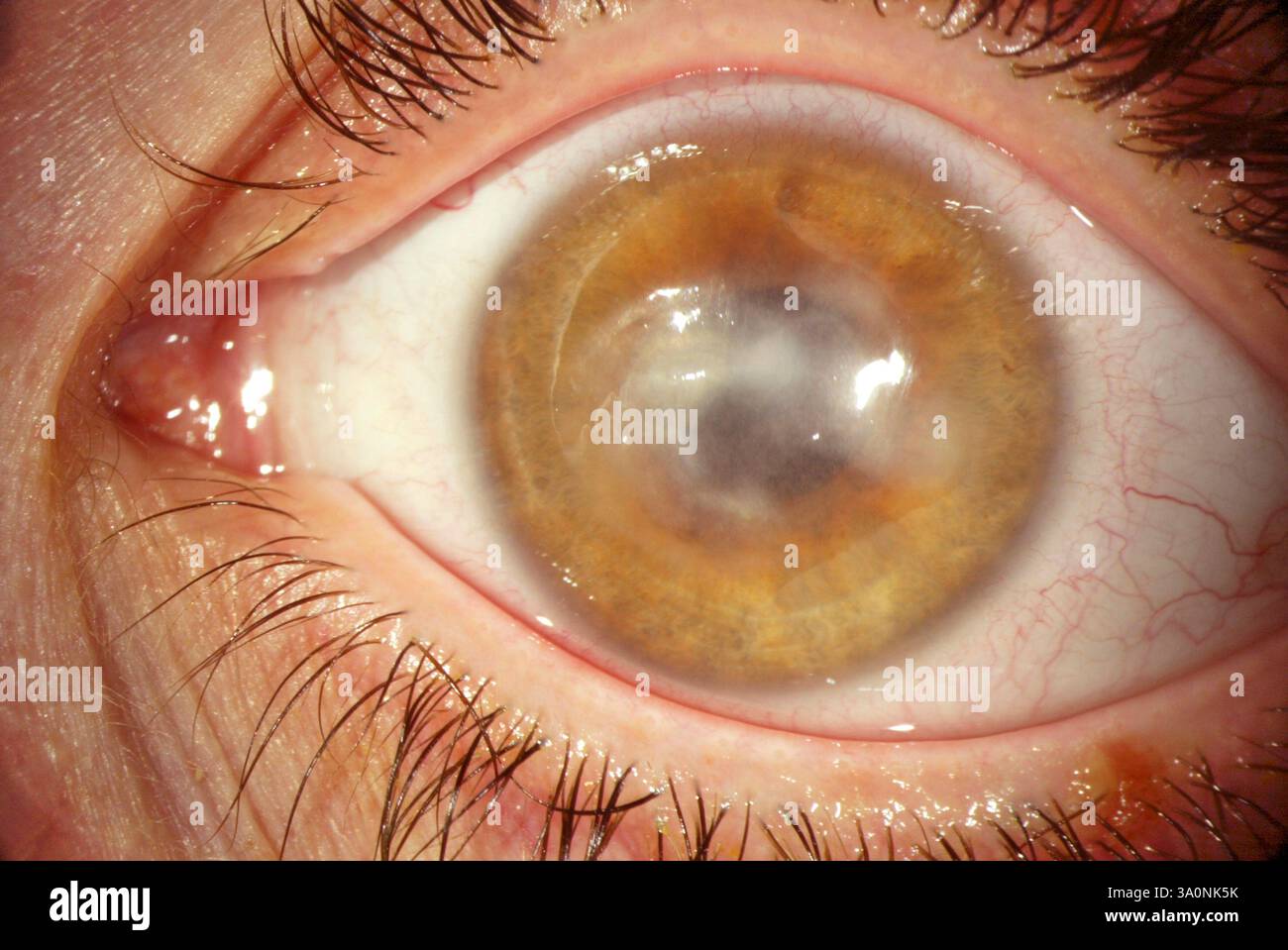 Acanthamoeba keratitis. Close-up of the left eye of a patient with ...