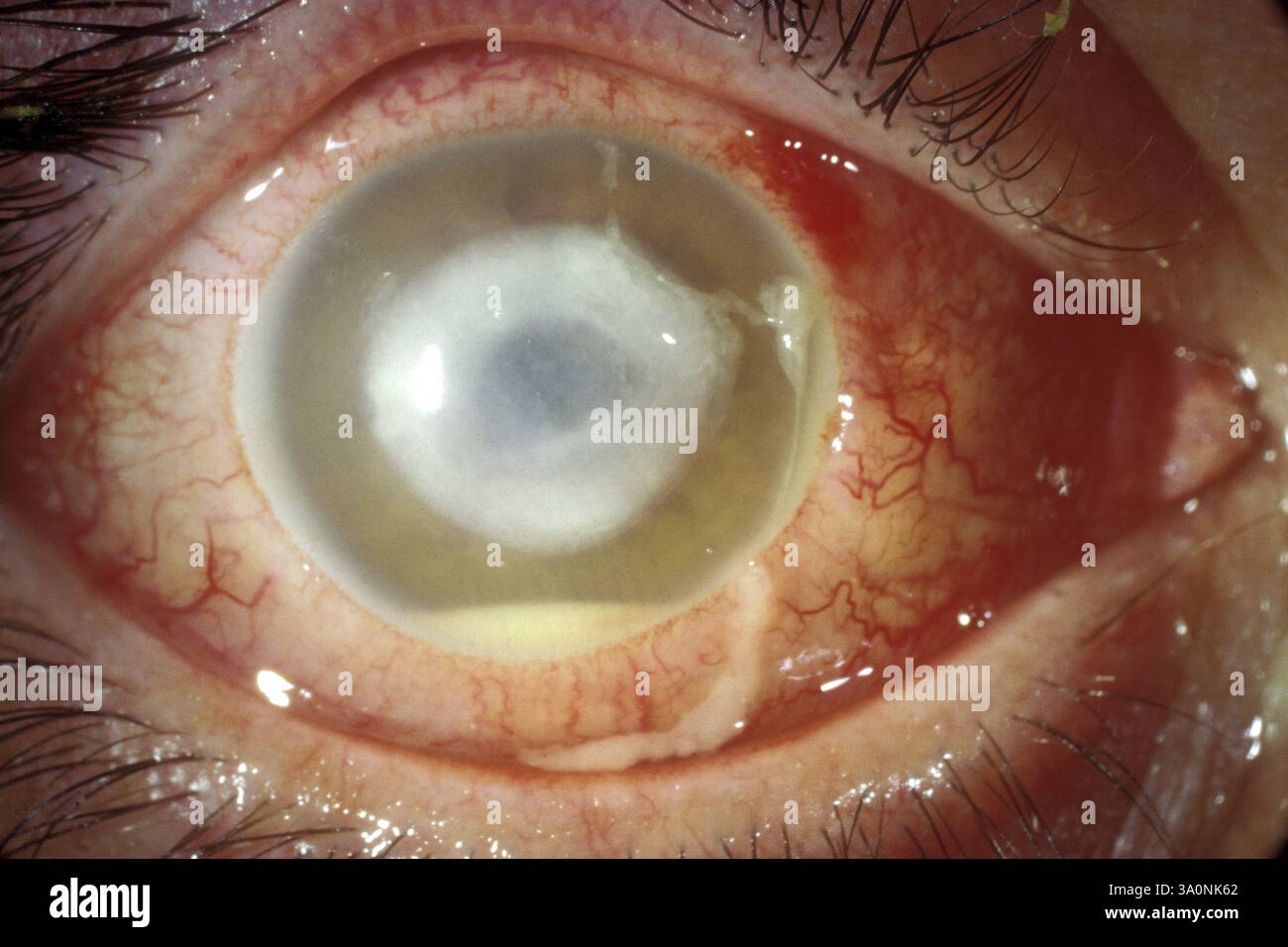 Corneal abscess and hypopyon. Close-up of the right eye of a patient ...