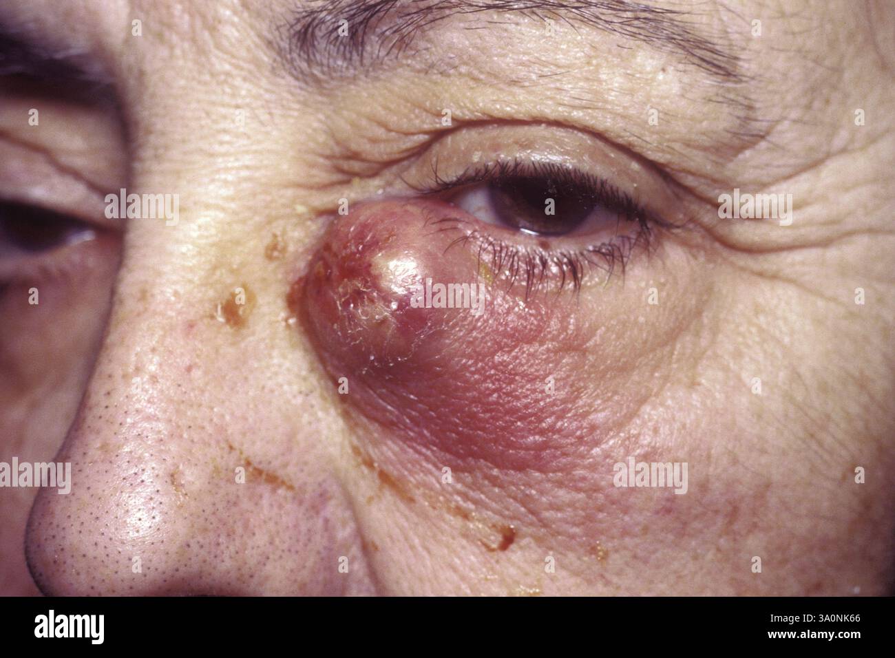 Infected tear sac. Dacryocystitis (inflammation of the lacrimal (tear ...