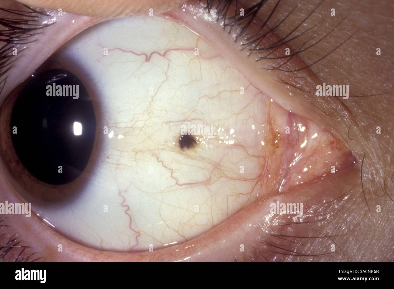 Conjunctival naevus. Close-up of the right eye of a patient with a ...