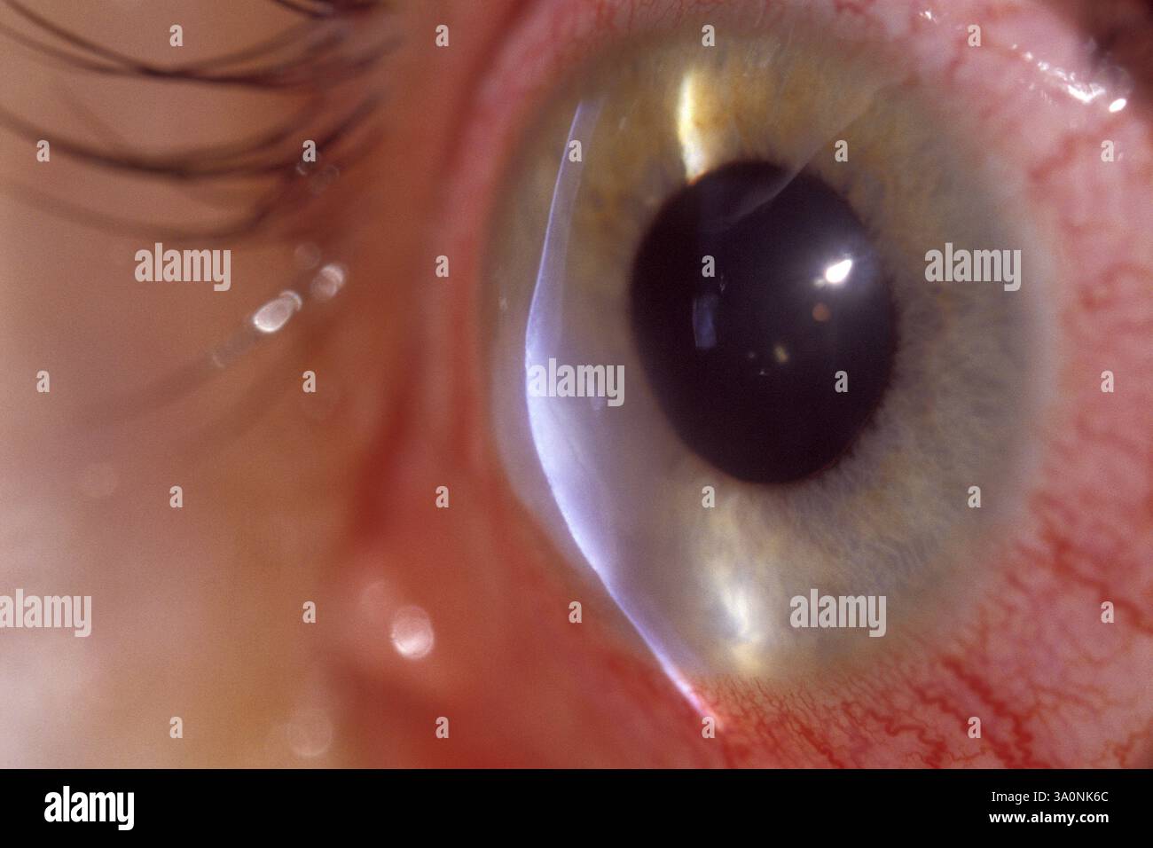 Corneal ulcer. Slit-lamp examination of the left eye of a patient with ...
