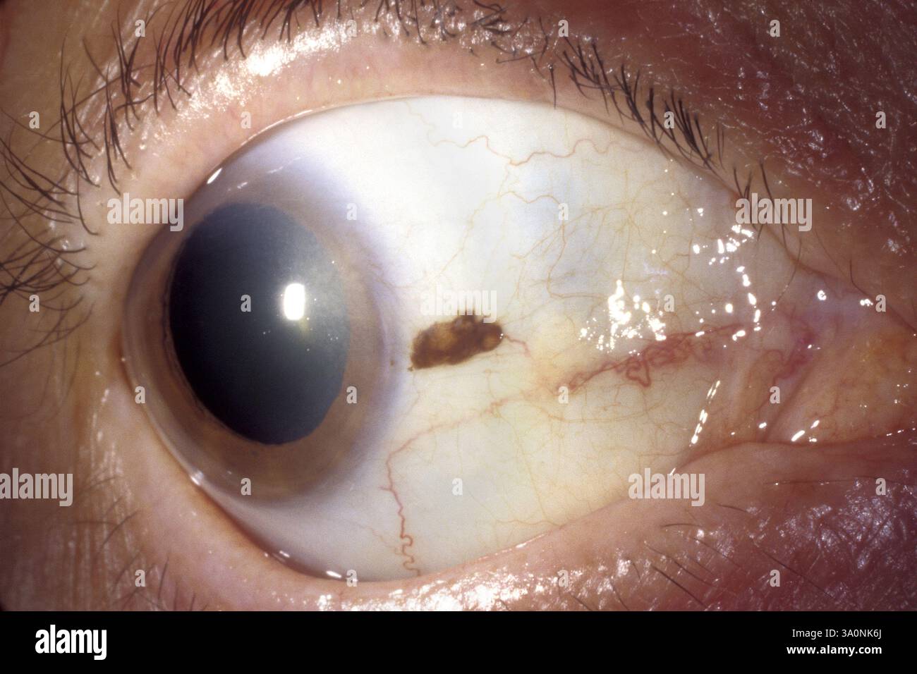 Conjunctival naevus. Close-up of the right eye of a patient with a ...