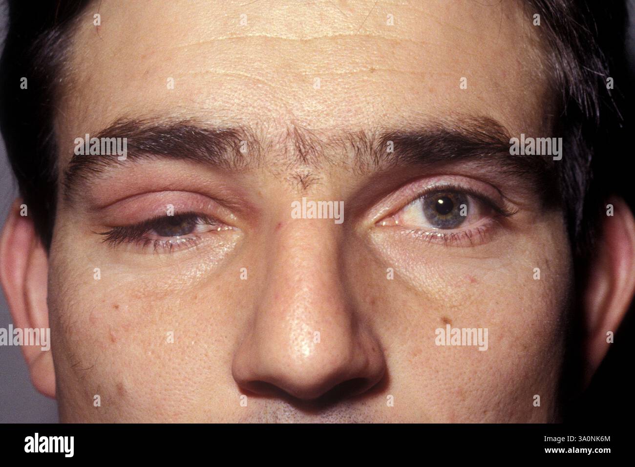 Drooping eyelid. Drooping eyelid (ptosis) of the right eye of a male ...