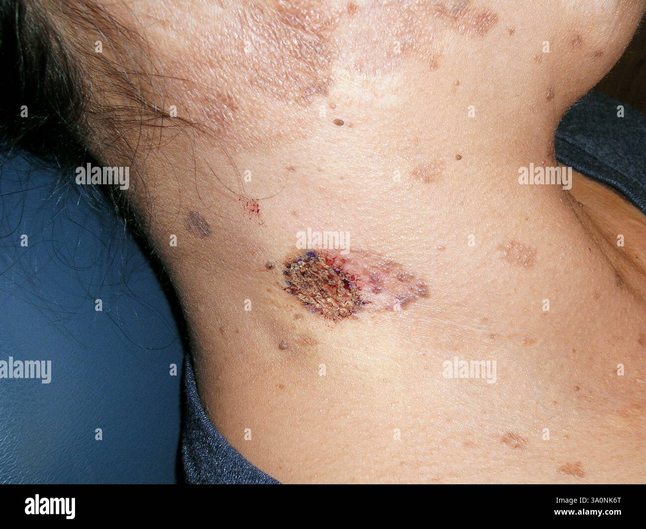 Basal cell nevus syndrome Stock Photo - Alamy