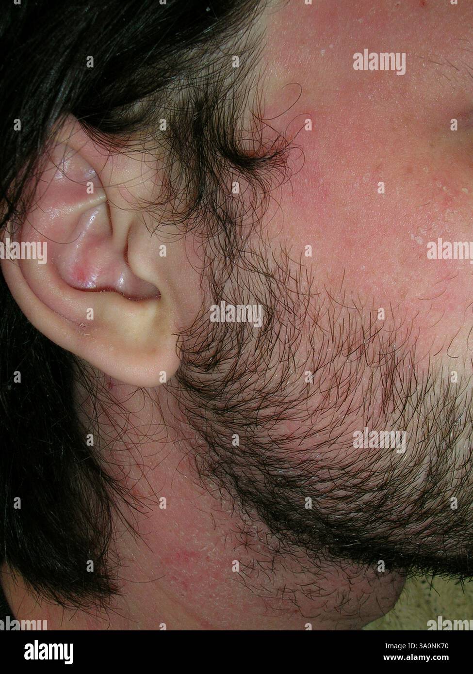 Atopic dermatitis and oily skin, or seborrhea, on the head and neck of ...