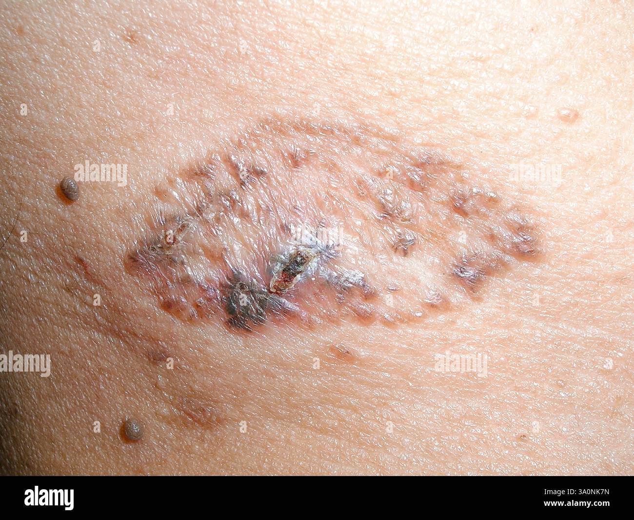 Basal cell nevus syndrome Stock Photo - Alamy