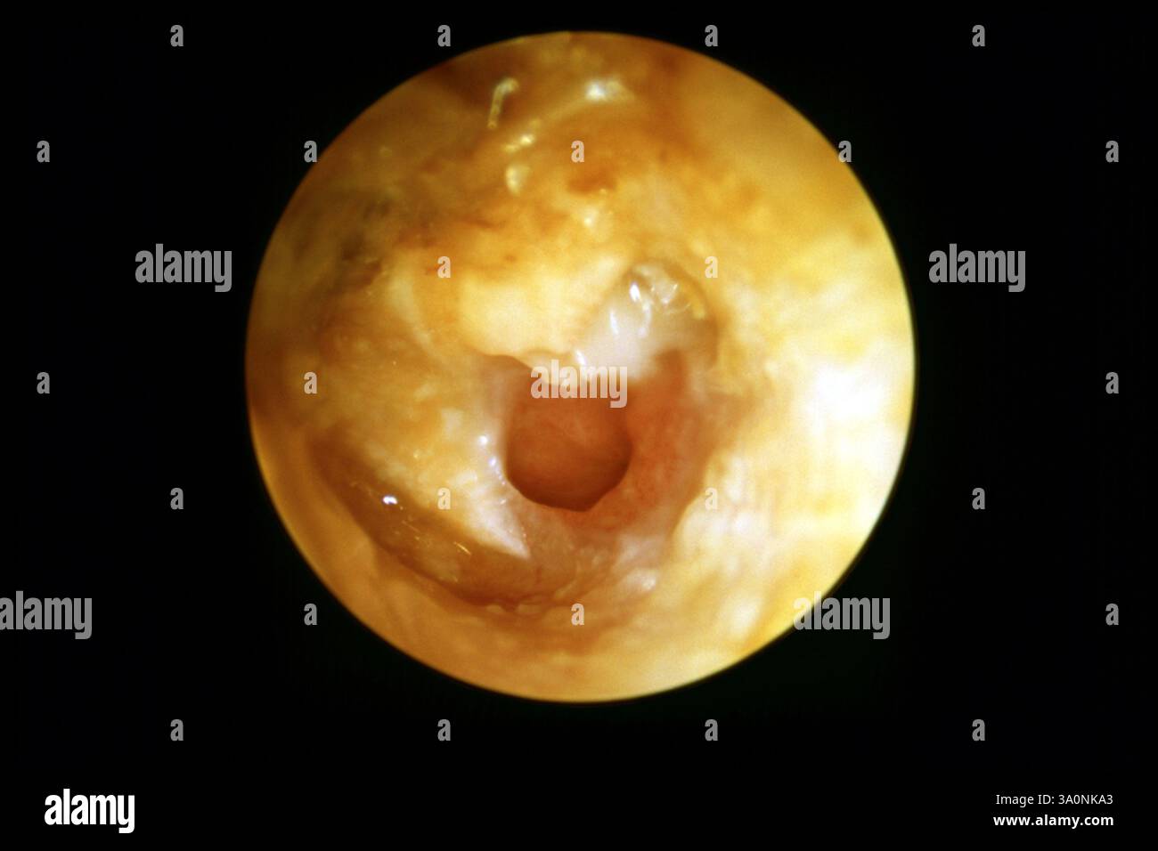 Middle ear infection. Otoscope view of the inside of the ear of a ...