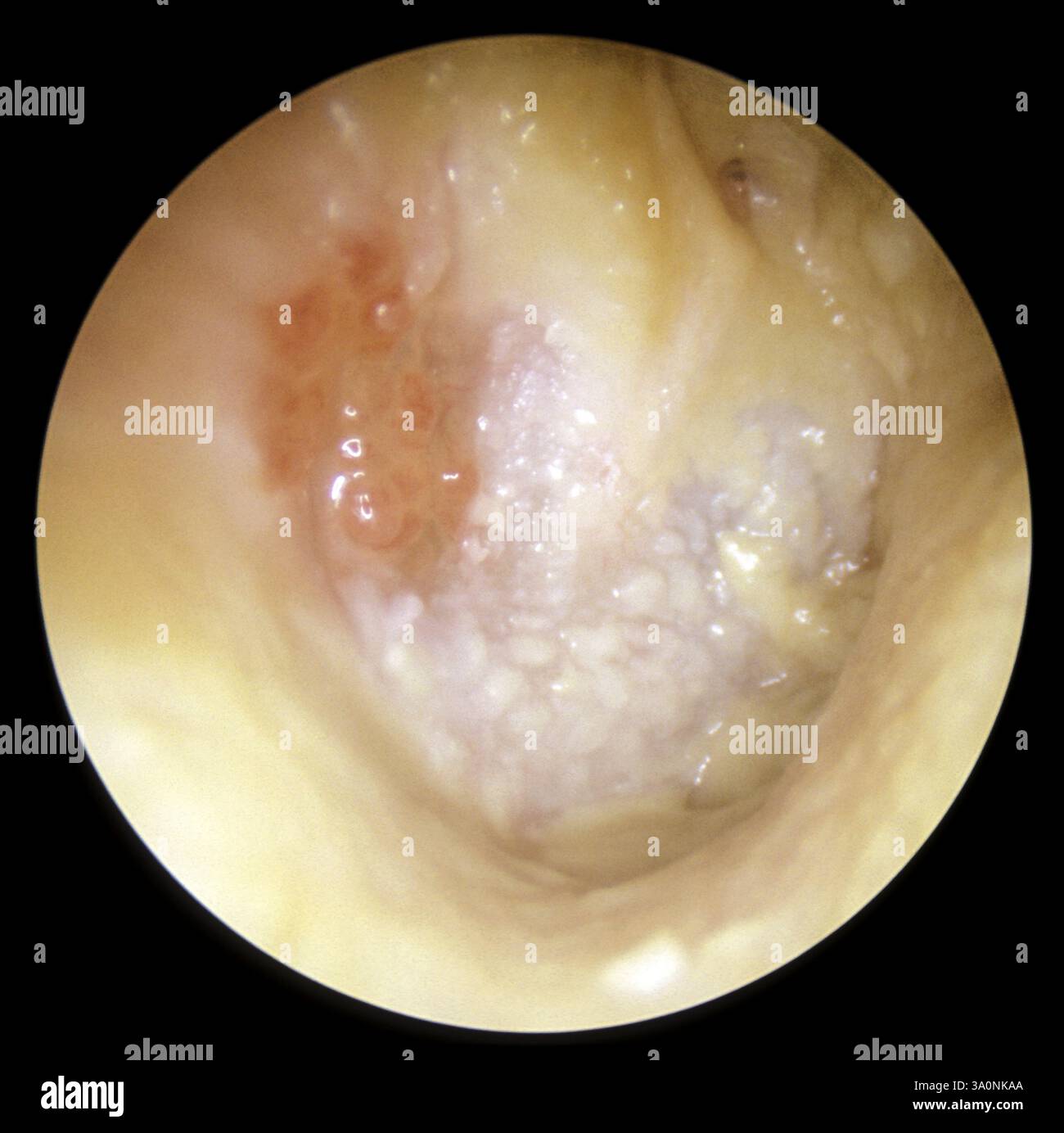 Eardrum infection. Otoscope view of the inside of a patient's ear ...