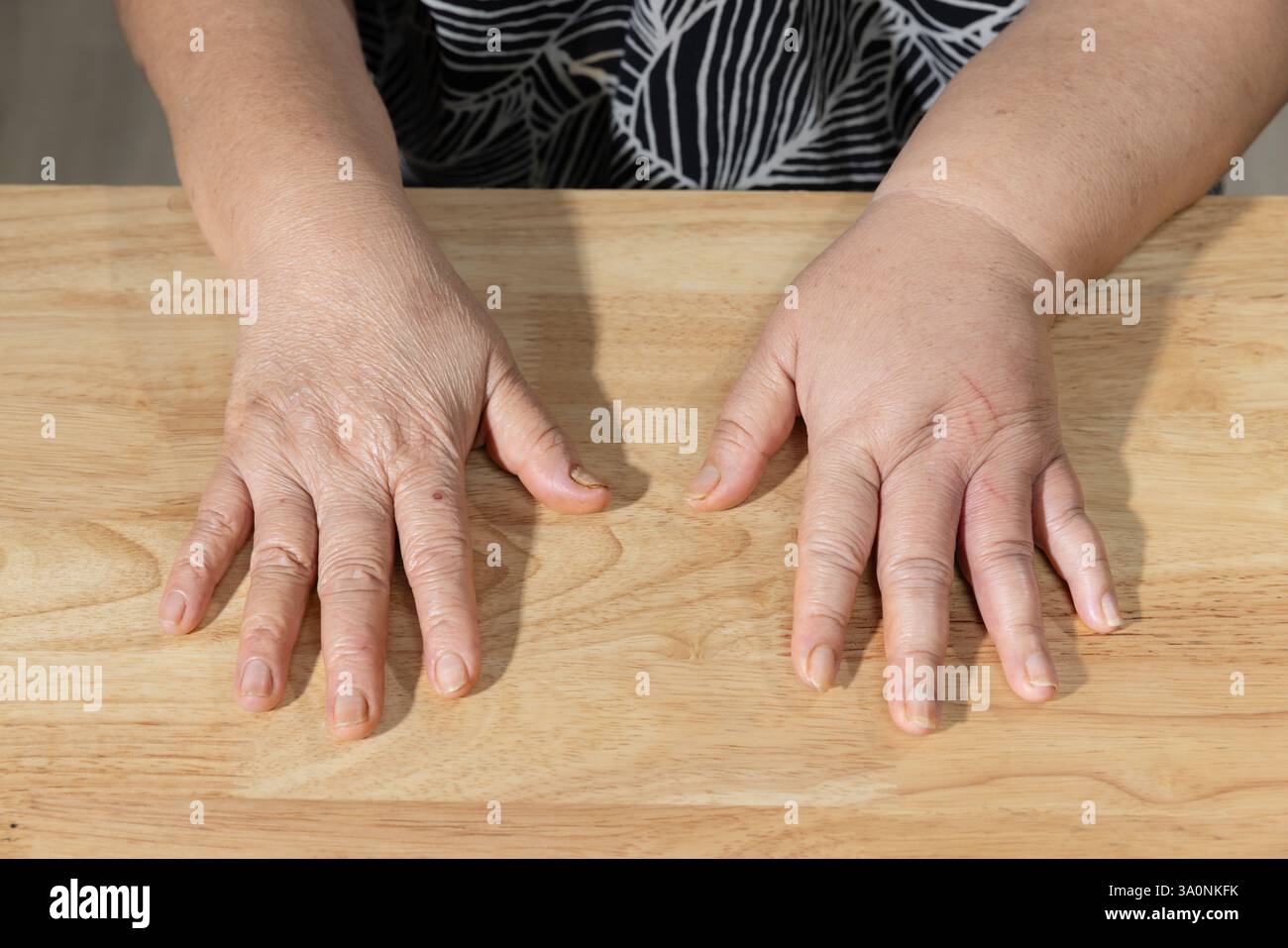 Cancer chemotherapy cause swelling hand , skin to become dry, dark or ...