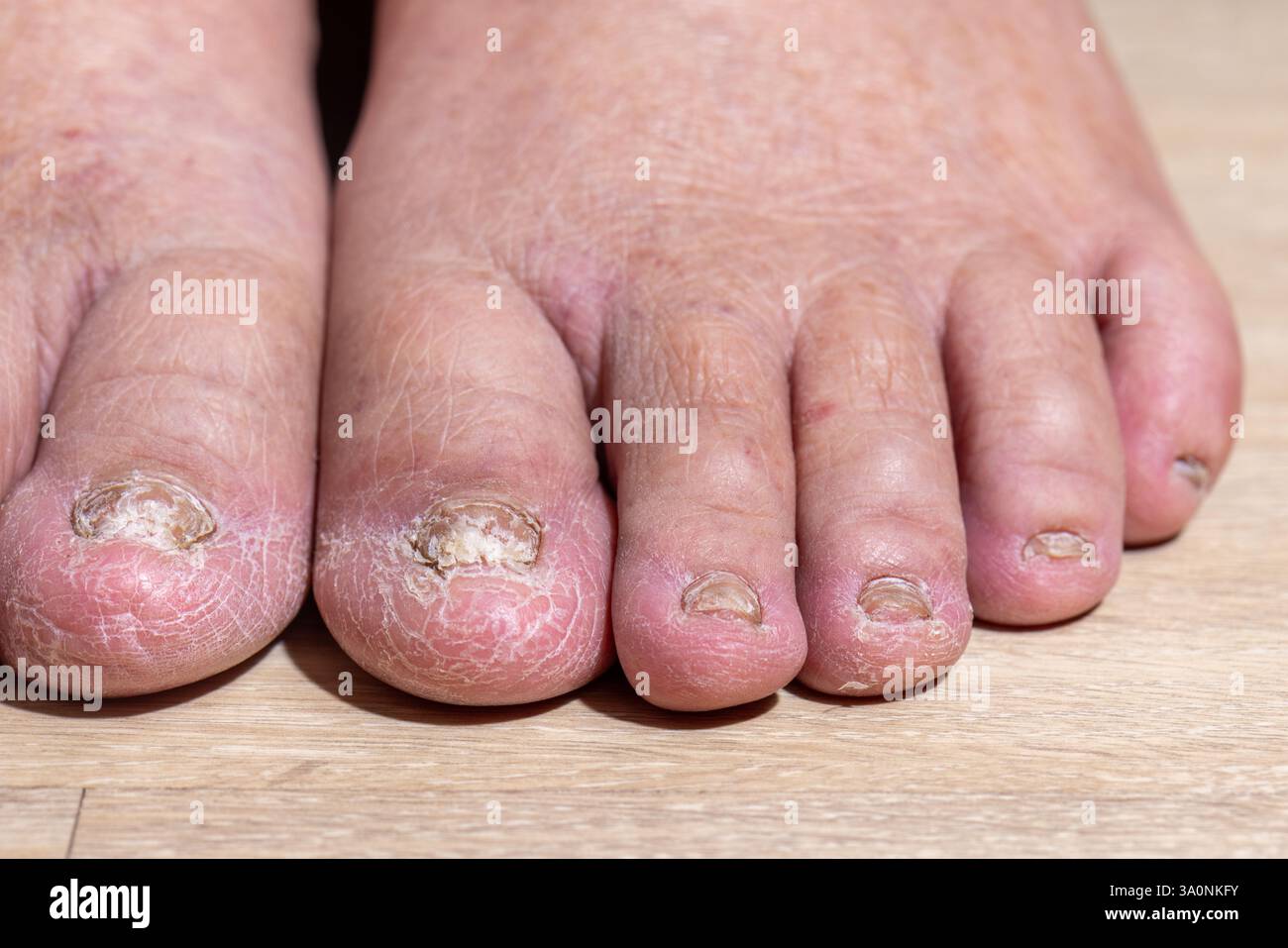 Cancer chemotherapy cause swelling of ankles (ankle oedema) , skin to ...