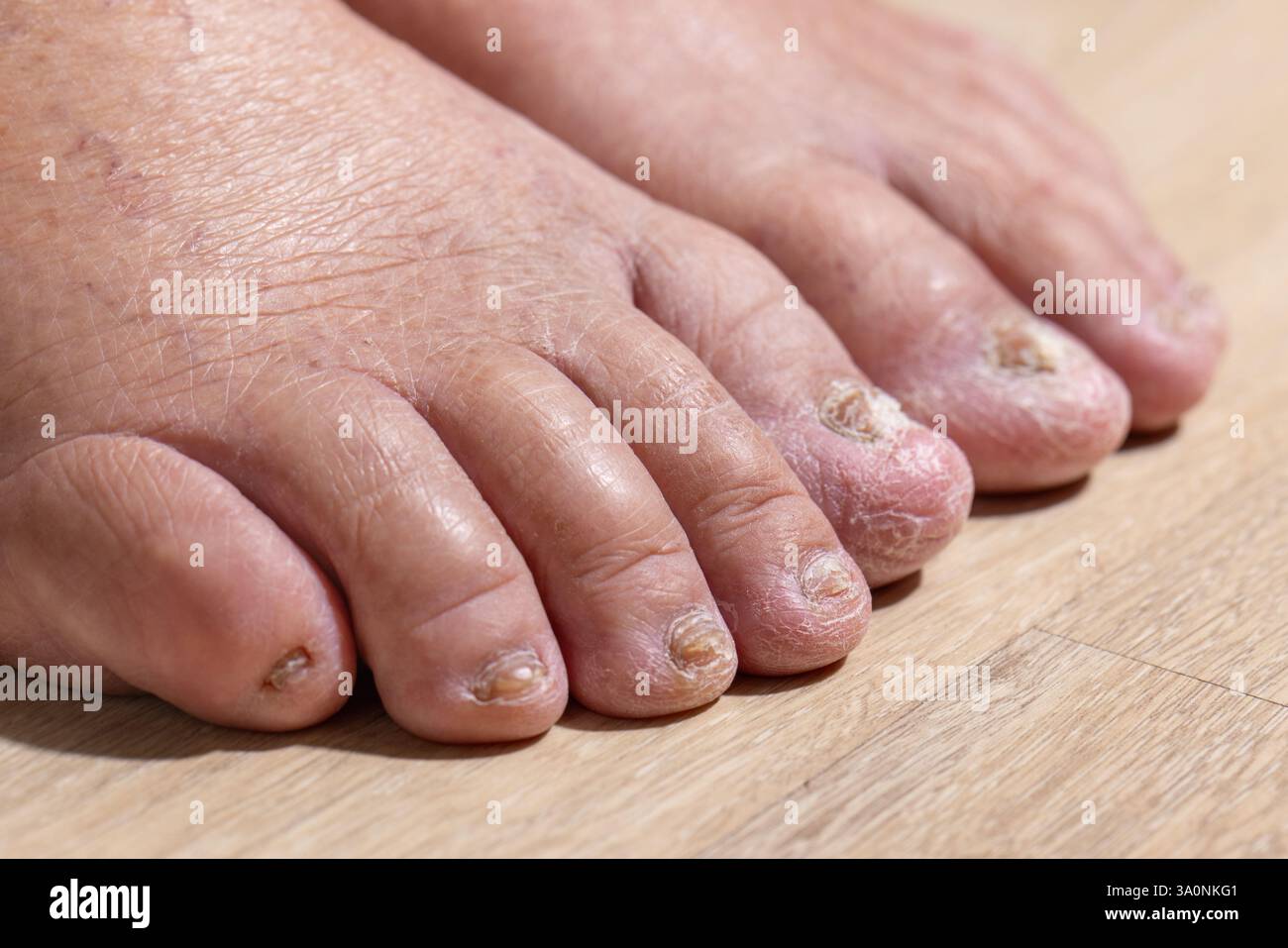 Cancer chemotherapy cause swelling of ankles (ankle oedema) , skin to ...