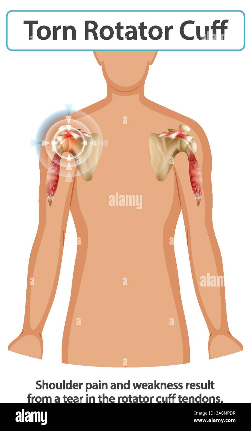 Illustration of shoulder anatomy and injury details Stock Vector Image ...