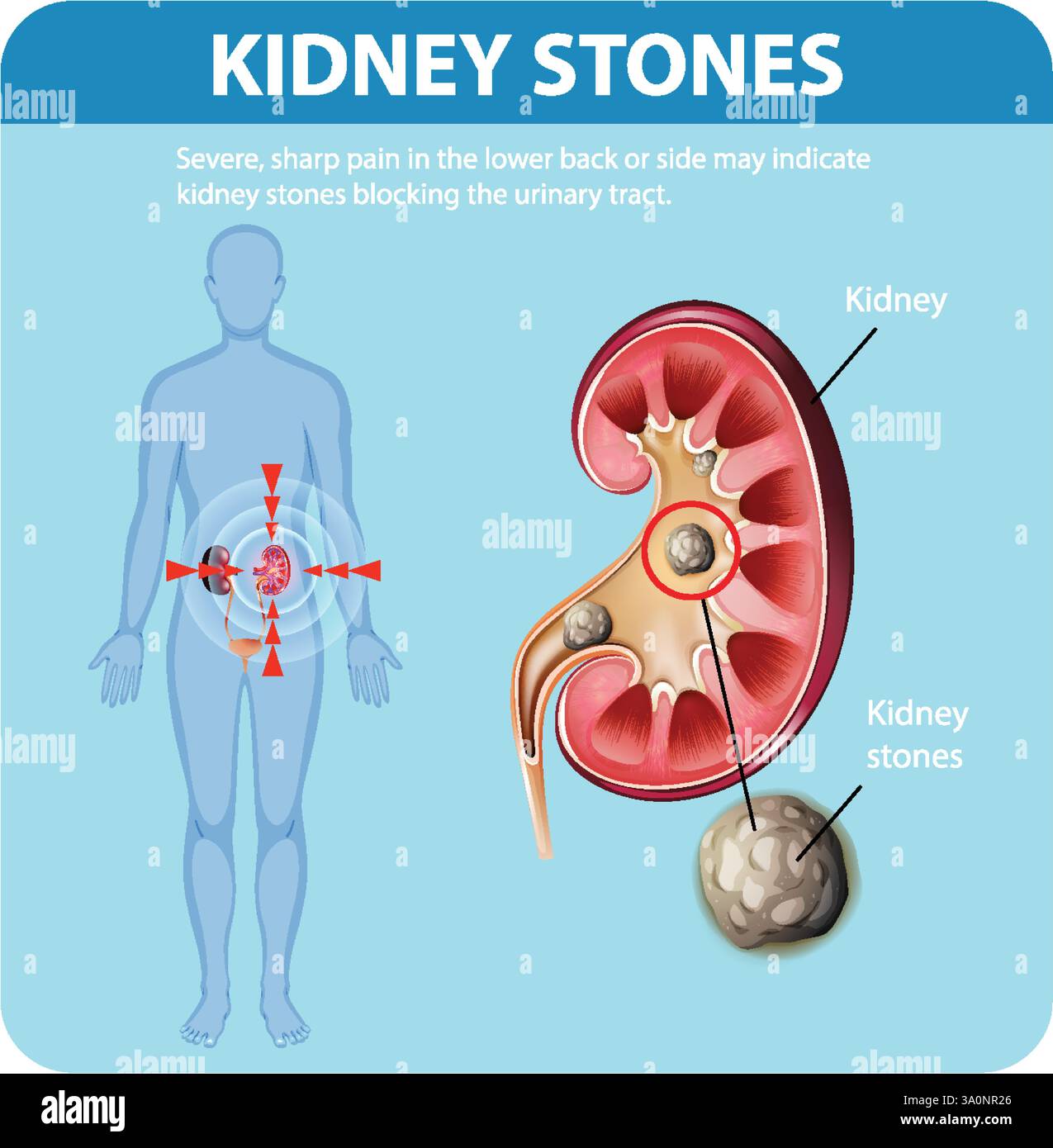 Illustration of kidney stones causing severe pain Stock Vector Image ...