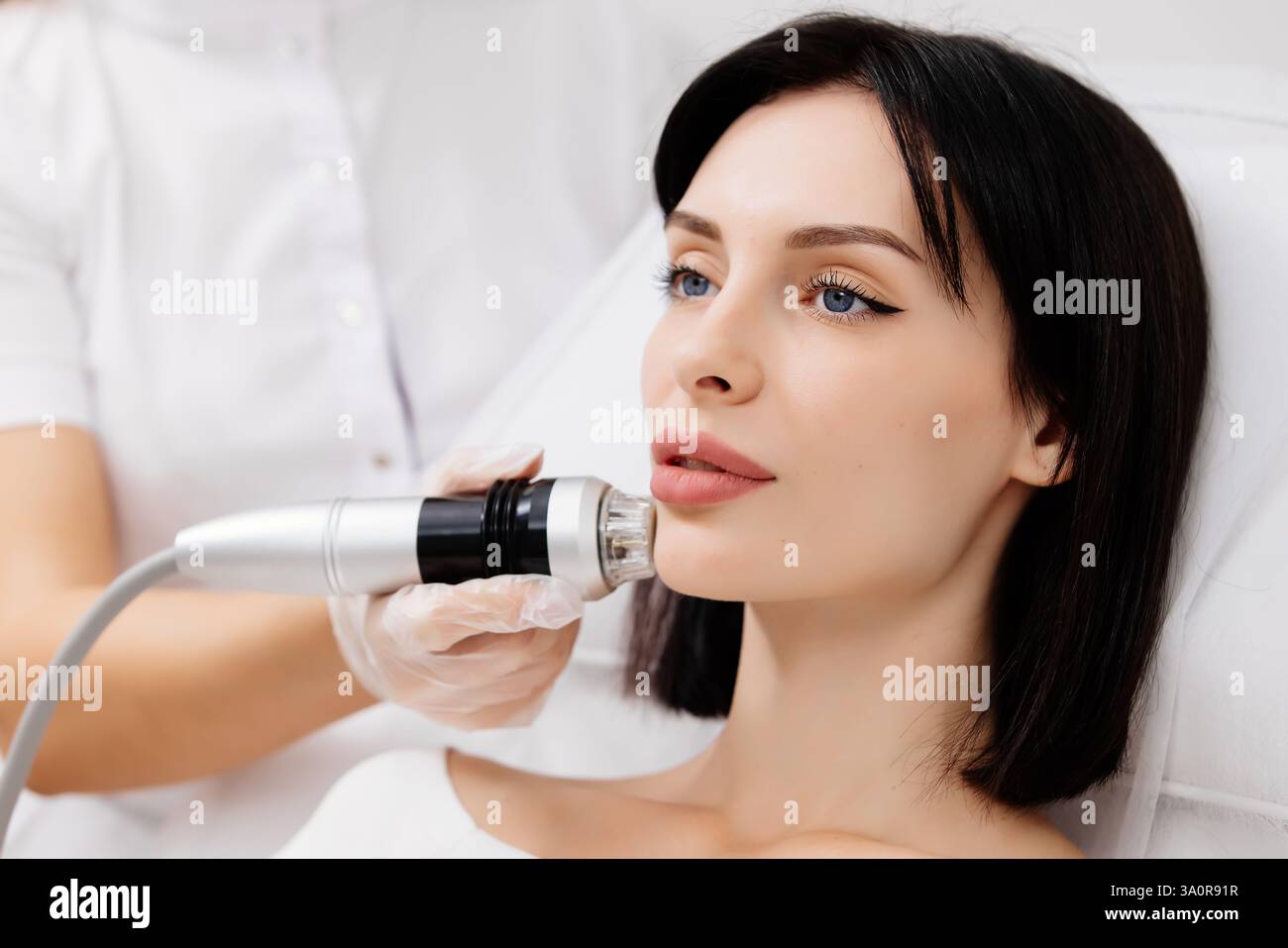 A young woman undergoes a fractional radiofrequency needle procedure ...