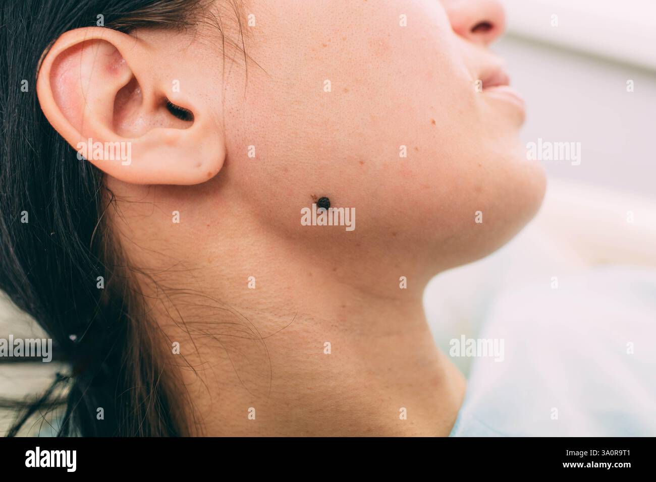A woman is receiving a skin examination at a medical clinic, focusing ...