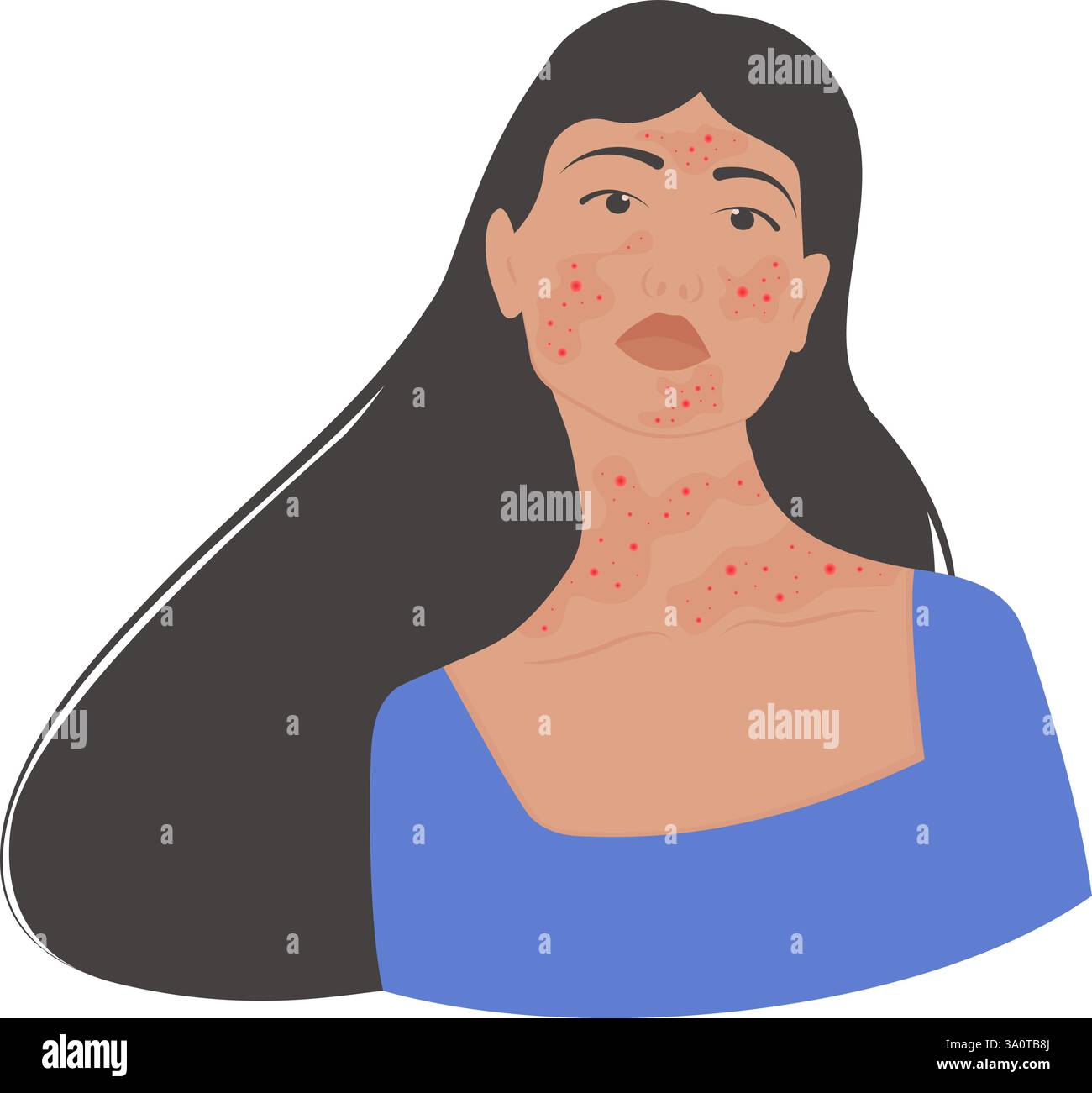 Woman with demodicosis, psoriasis skin disease. Rosacea Awareness Month ...