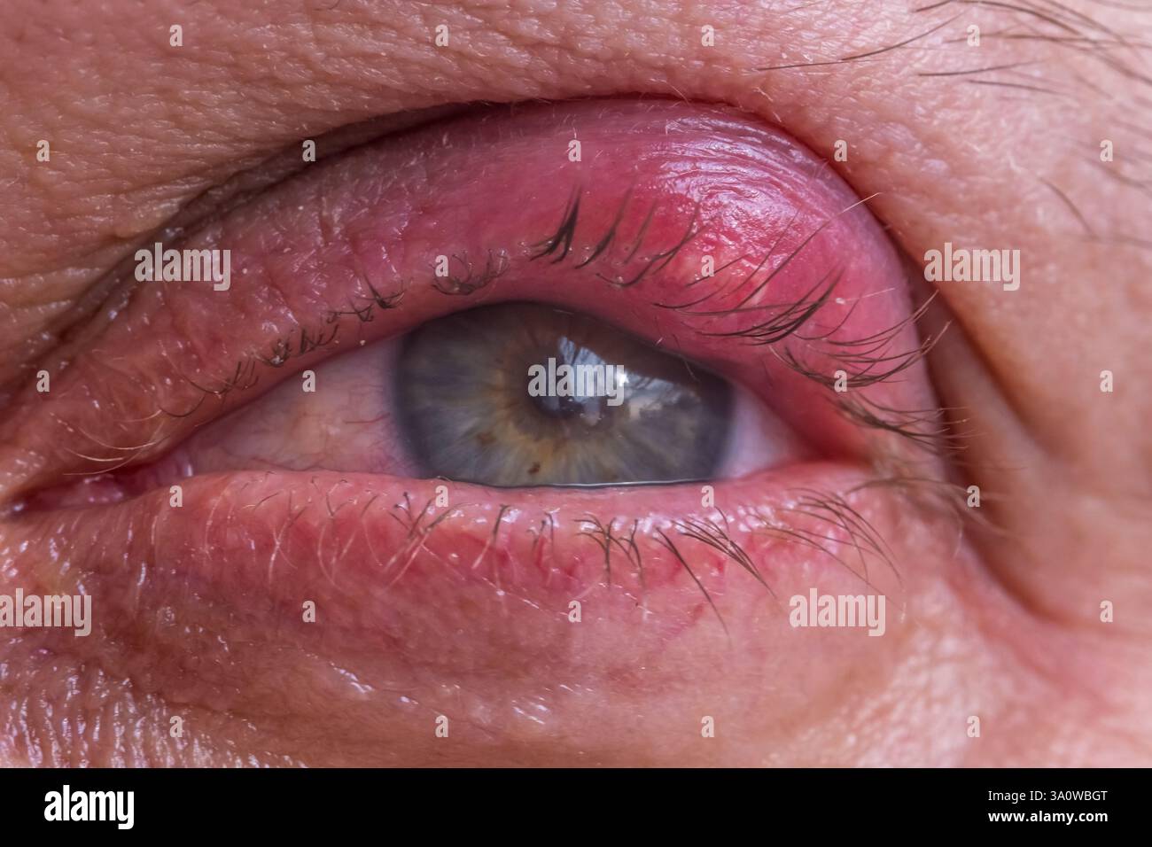 disease barley on the eye. redness of the skin and inflammation of the ...