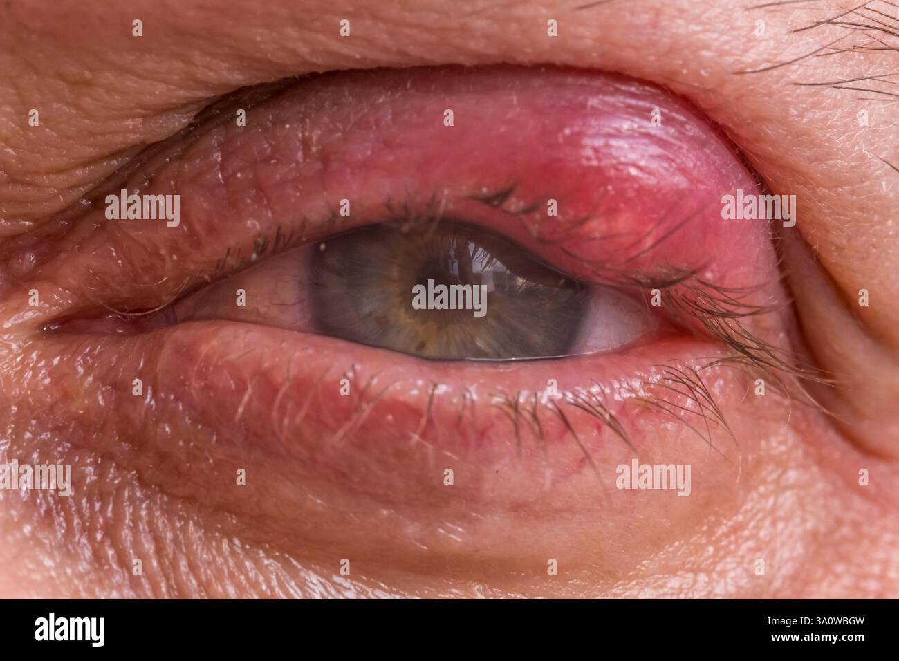 disease barley on the eye. redness of the skin and inflammation of the ...