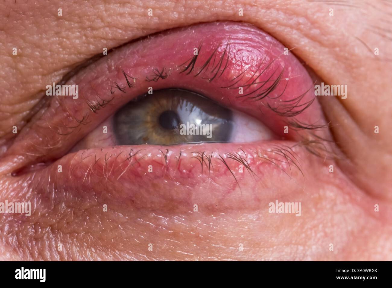 disease barley on the eye. redness of the skin and inflammation of the ...