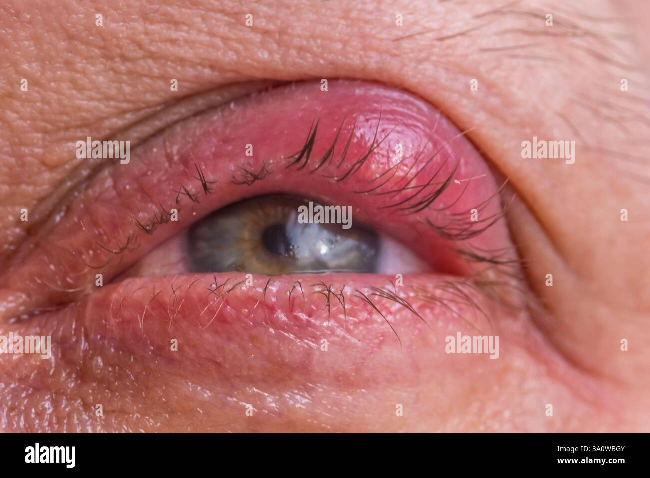 disease barley on the eye. redness of the skin and inflammation of the ...