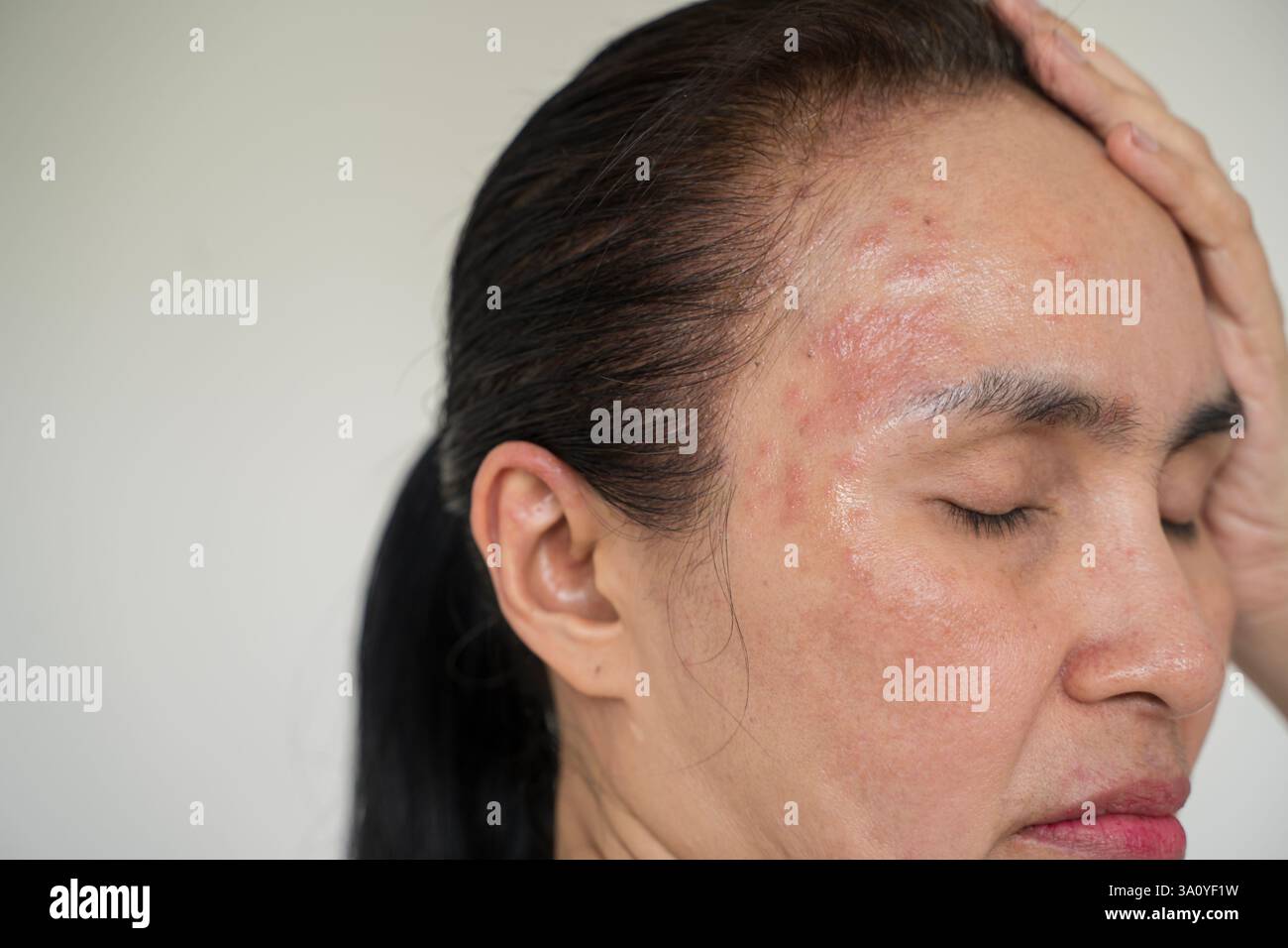 closeup acne on woman's face with rash skin ,scar and spot that ...