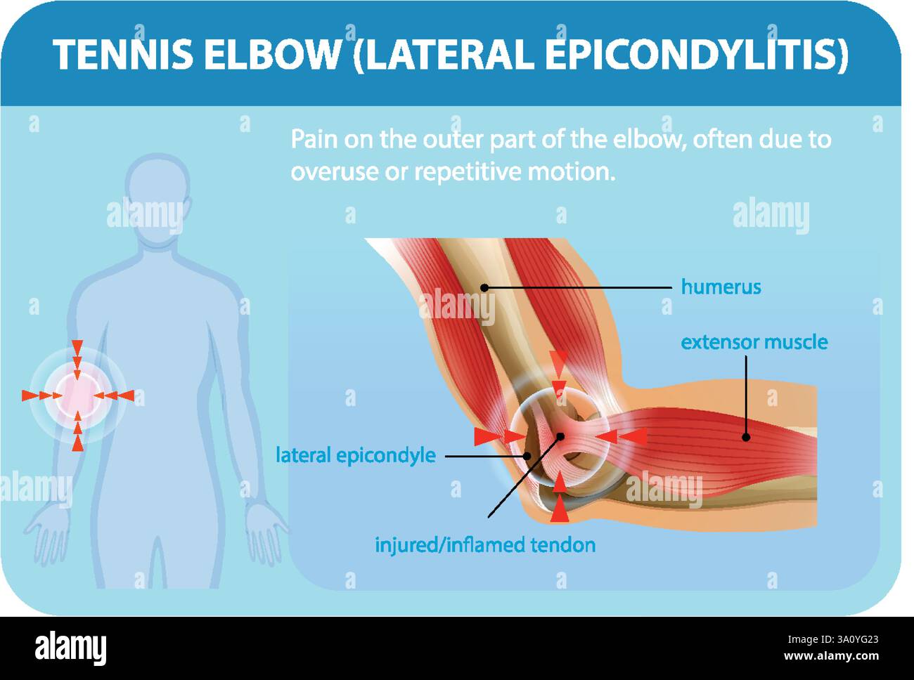 Illustration of tennis elbow anatomy and symptoms Stock Vector Image & Art - Alamy