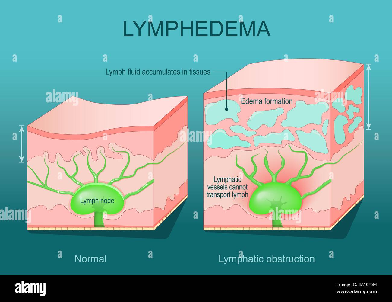 Lymphedema. Cross section of a human skin with healthy lymphatic system ...