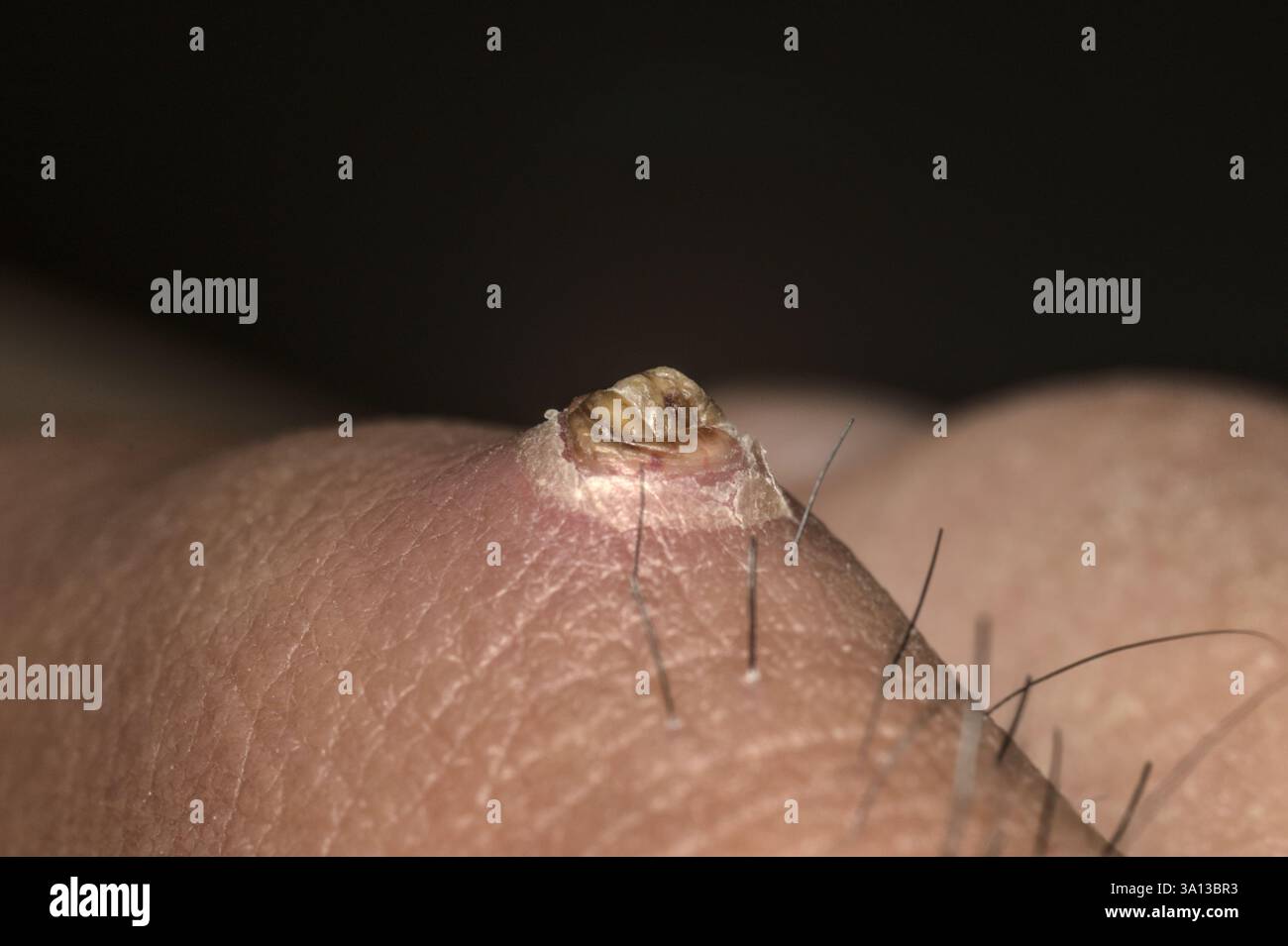 The sore on the toe joint has completely hardened Stock Photo - Alamy