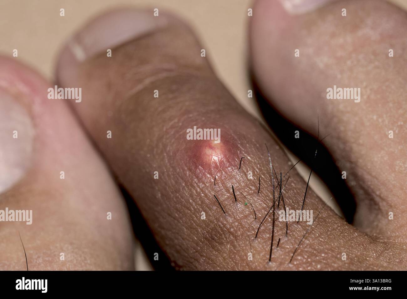 early stage sore on toe joint Stock Photo - Alamy