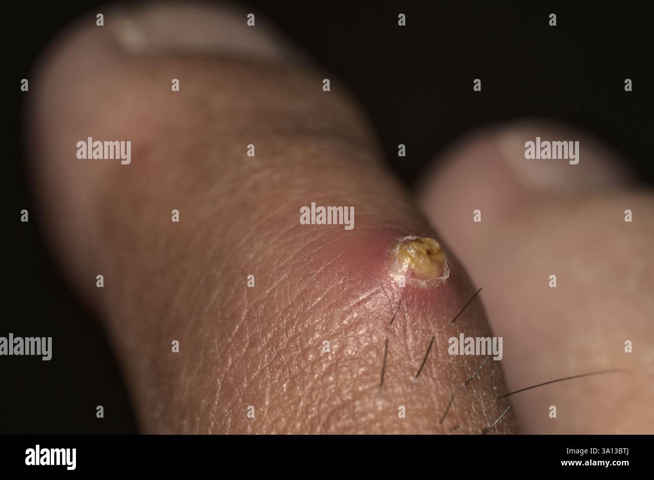 The sore on the toe joint has completely hardened Stock Photo - Alamy