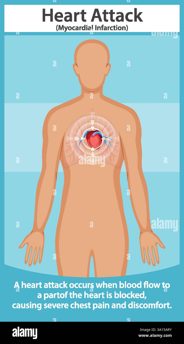 Illustration of heart attack and its effects Stock Vector Image & Art ...