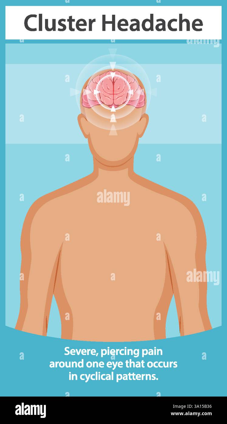 Illustration of cluster headache pain and patterns Stock Vector Image ...