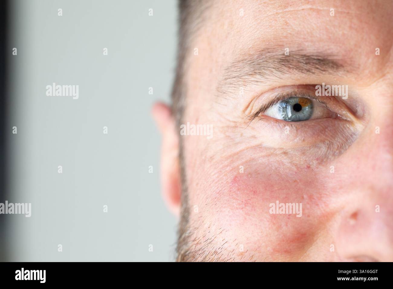 Half face of man with blue eye and brown spot, focusing on eye health ...