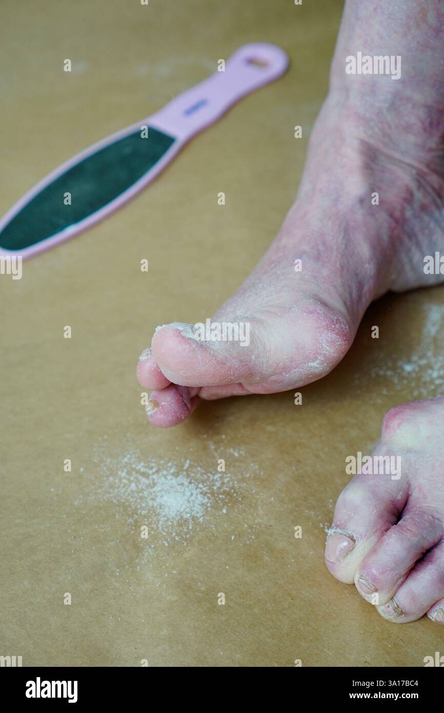 Pedicure process for toenails with fungal infection and arthritis. High ...