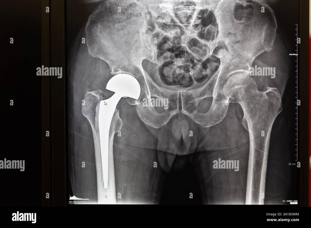 X-ray of hip joint endoprostheses on the monitor screen. Medicine ...