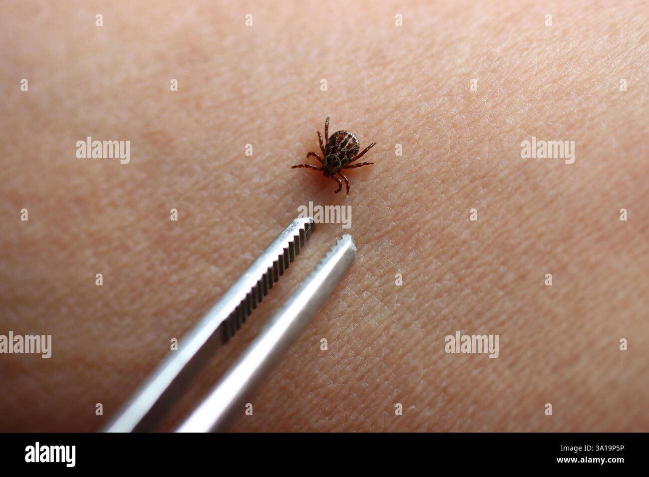 Remove a tick with a tweezer hi-res stock photography and images - Alamy