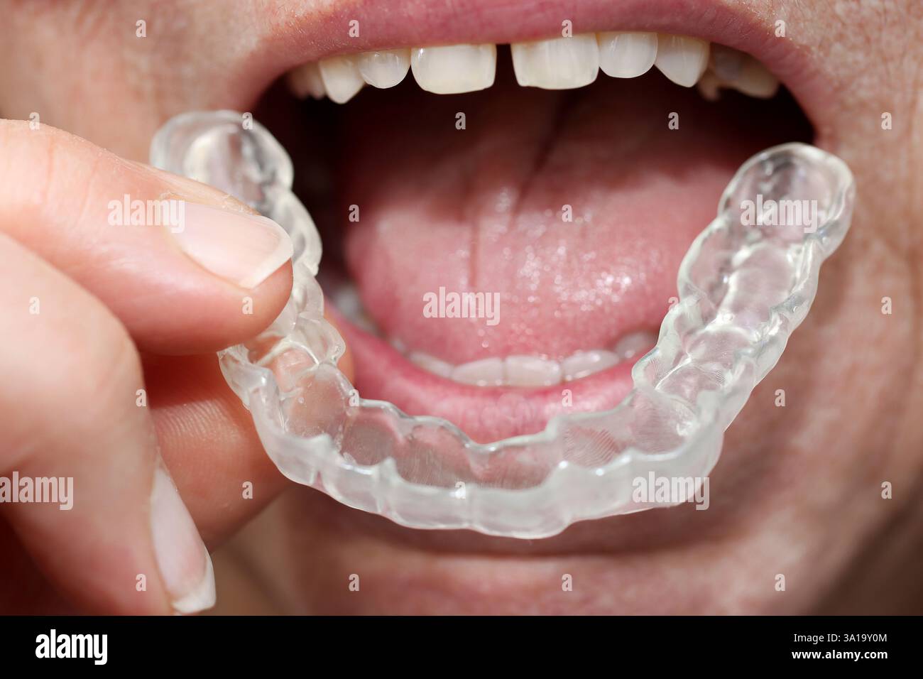A grinding splint prevents the teeth from wearing down Stock Photo - Alamy
