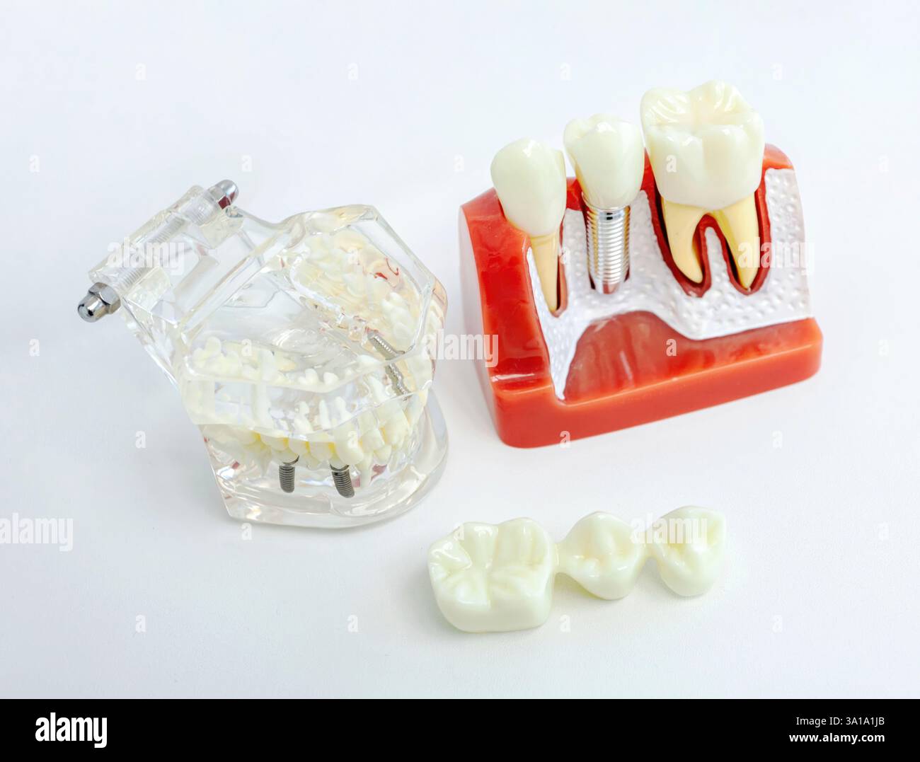 Educational dental models showing implants, dentures, and a transparent ...