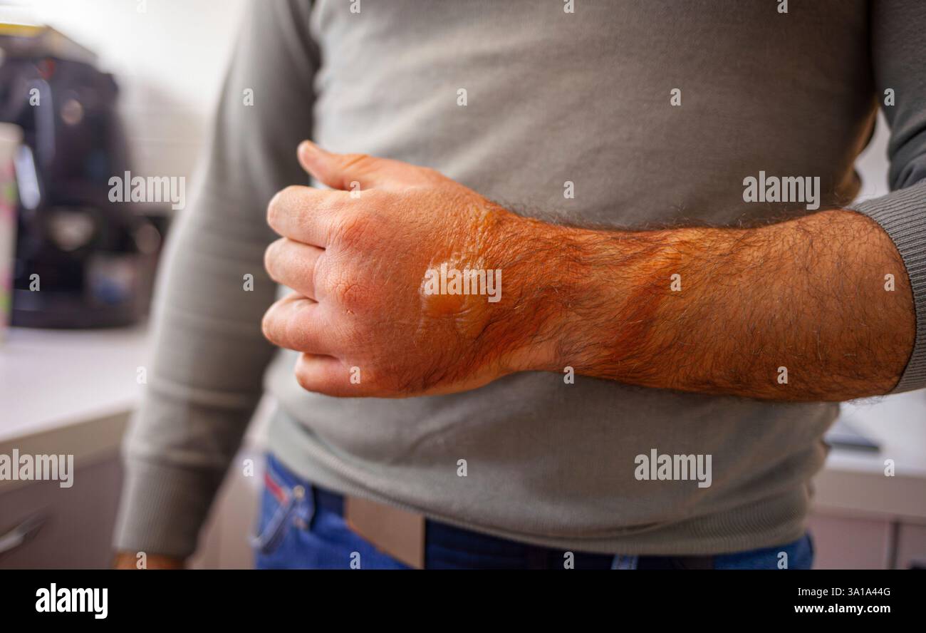 A man's hand burned with boiling water. On it there are redness and ...