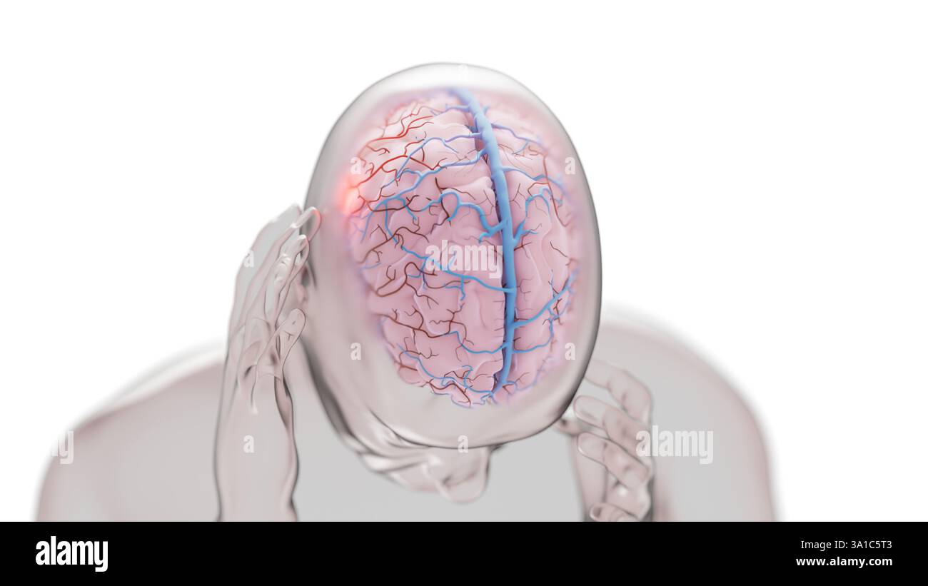 Conceptual illustration of pain symptoms originating from a brain ...