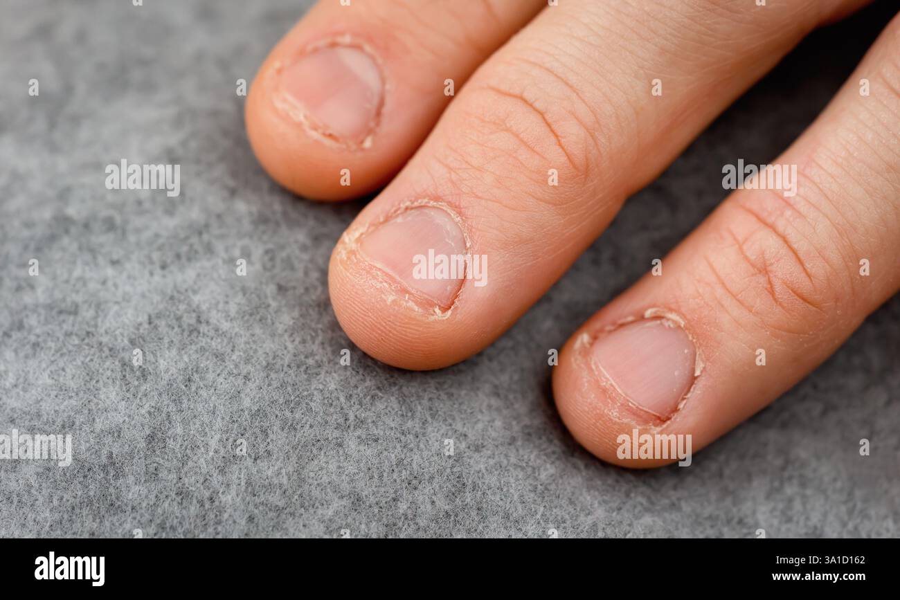 A men's bitten nails on his hand. Nail biting habit background Stock ...