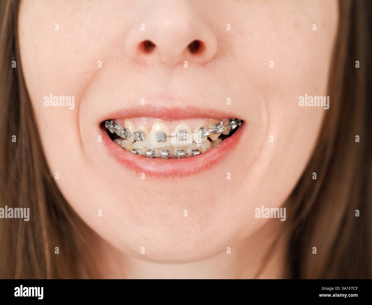 white female teeth in braces to correct bite, close-up Stock Photo - Alamy
