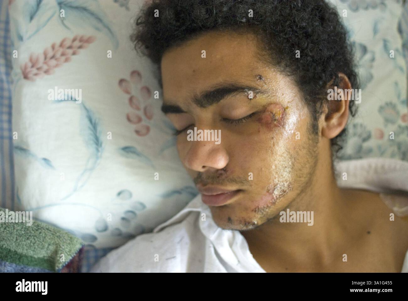 Injured young man with twelve stitches on the face sleeping in Hospital ...