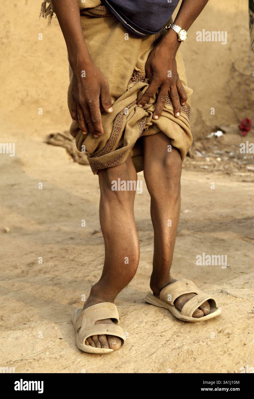 Polio affected man, Rajouli, Nawada, Bihar, India, Asia Stock Photo - Alamy