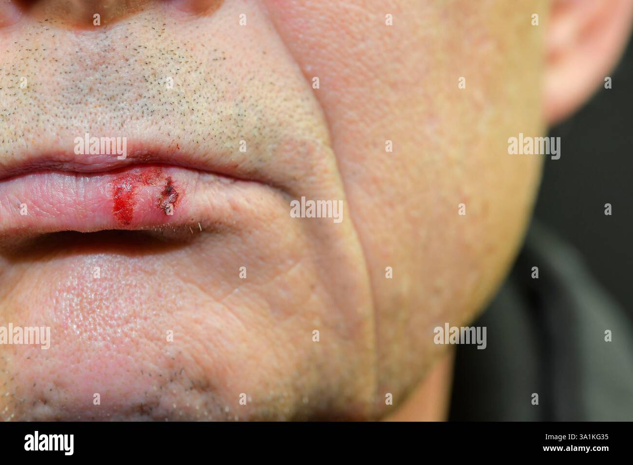 Oral herpes on the lip. Cold sore on the mouth. Fever blister on lips ...