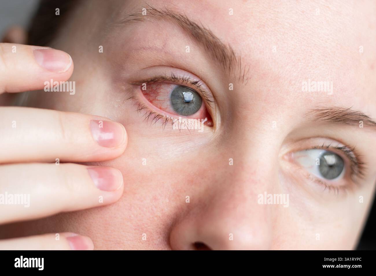 Close up of female face with one red eye suffering from infection ...