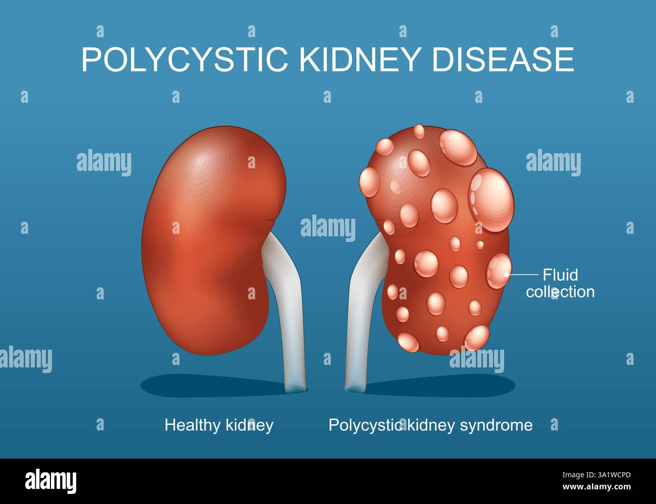 Polycystic kidney disease. Normal human kidney and polycystic kidney ...